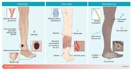 Chronic wounds - Knowledge @ AMBOSS