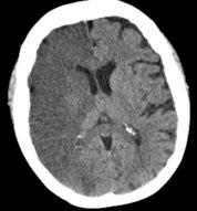 Overview of stroke - Knowledge @ AMBOSS