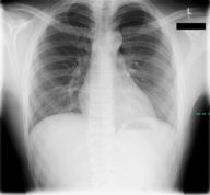 Chest x-ray - Knowledge @ AMBOSS