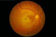 Eye pain and red eye - Knowledge @ AMBOSS