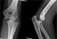 Radial head subluxation - Knowledge @ AMBOSS