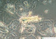 Systemic lupus erythematosus - Knowledge @ AMBOSS