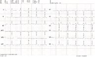 Supraventricular tachycardia - Knowledge @ AMBOSS