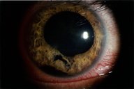 Traumatic eye injuries - Knowledge @ AMBOSS