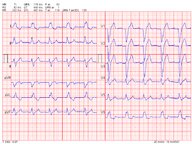 ECG - Knowledge @ AMBOSS