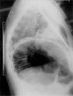Chest x-ray - Knowledge @ AMBOSS