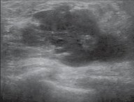 Abscess incision and drainage - Knowledge @ AMBOSS