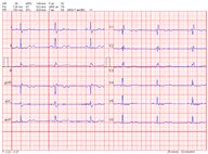 High-grade AV block [2] [7]