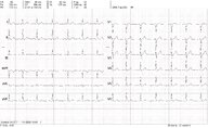 ECG - Knowledge @ AMBOSS