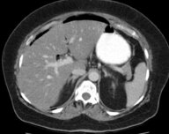 IV contrast is preferred if bowel perforation is suspected. If oral ...