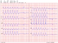 Option 1: Unstable tachycardia - Knowledge @ AMBOSS
