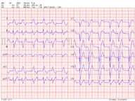 Atrial fibrillation - Knowledge @ AMBOSS