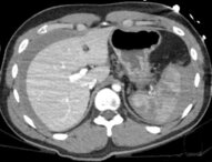 Splenic injuries - Knowledge @ AMBOSS
