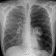 Pneumothorax - Knowledge @ AMBOSS