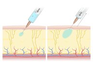 Local anesthesia for wound repair [2]