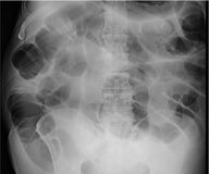 Bowel obstruction - Knowledge @ AMBOSS