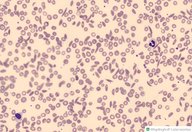 Sickle cell disease - Knowledge @ AMBOSS