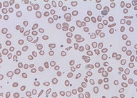 Hemolytic uremic syndrome - Knowledge @ AMBOSS