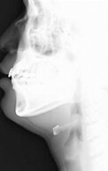 Epiglottitis - Knowledge @ AMBOSS