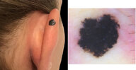 Nevus - Knowledge @ AMBOSS
