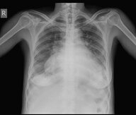 Heart failure - Knowledge @ AMBOSS