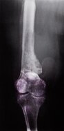 Primary malignant bone tumors - Knowledge @ AMBOSS