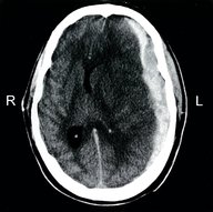 Elevated intracranial pressure and brain herniation - Knowledge @ AMBOSS