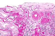 Atherosclerotic cardiovascular disease - Knowledge @ AMBOSS