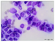 Acute leukemia - Knowledge @ AMBOSS