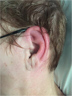 Ear injuries - Knowledge @ AMBOSS