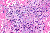 IgA vasculitis - Knowledge @ AMBOSS