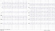 Supraventricular tachycardia - Knowledge @ AMBOSS