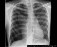 Chest x-ray - Knowledge @ AMBOSS