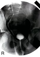 Diagnostic investigations and procedures in urology - Knowledge @ AMBOSS