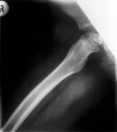 Legg-Calvé-Perthes disease - Knowledge @ AMBOSS