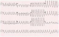 Supraventricular tachycardia - Knowledge @ AMBOSS