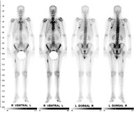 Bone metastases - Knowledge @ AMBOSS