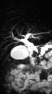 Chronic pancreatitis - Knowledge @ AMBOSS