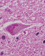 Amyotrophic lateral sclerosis - Knowledge @ AMBOSS