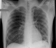Chest tube placement - Knowledge @ AMBOSS