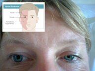 Horner syndrome - Knowledge @ AMBOSS