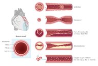 Myocardial infarction - Knowledge @ AMBOSS