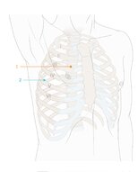 Chest tube placement - Knowledge @ AMBOSS