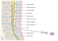 Regional anesthesia - Knowledge @ AMBOSS