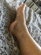 Peripheral edema - Knowledge @ AMBOSS