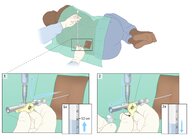Lumbar puncture - Knowledge @ AMBOSS