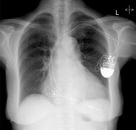 Cardiac implantable electronic devices - Knowledge @ AMBOSS