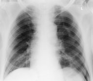 Pneumothorax - Knowledge @ AMBOSS