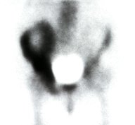 Bone scan - Knowledge @ AMBOSS