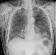 Pneumothorax - Knowledge @ AMBOSS